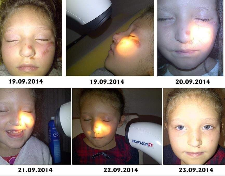 Lampa Zepter BIOPTRON Pro 1 + GRATIS z Filtrem Fulerenowym - Aparat ...